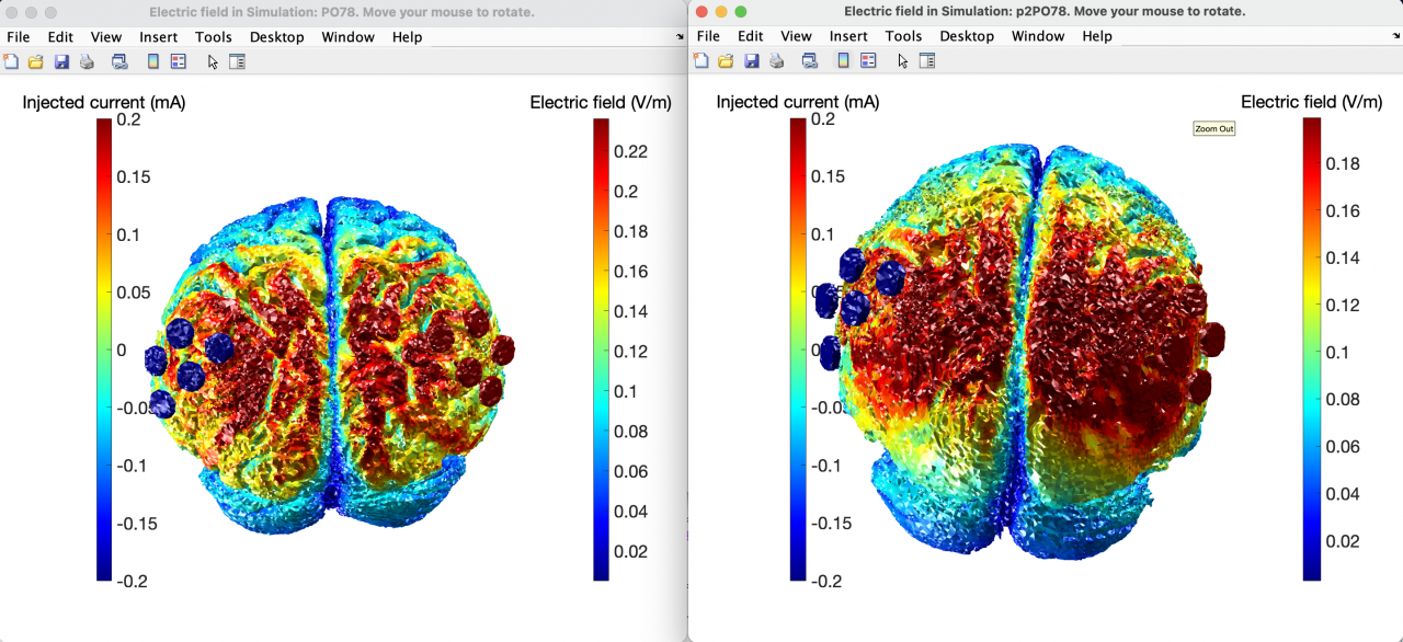 Neuromodulation to Stimulate Consciousness | BIAPT