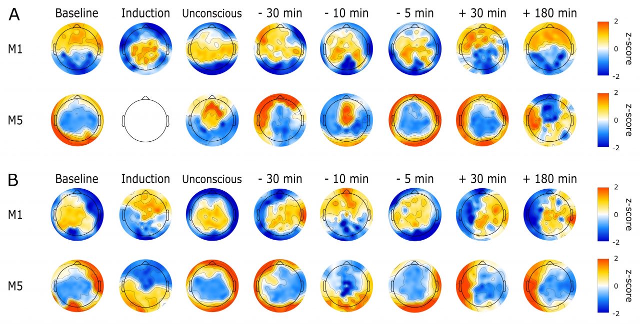 Neural Correlates of Concussion | BIAPT